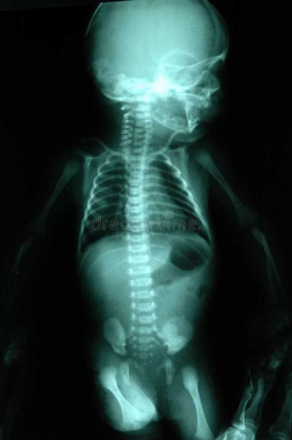 Black and green x-ray film stock image. Image of radiological - 8885547