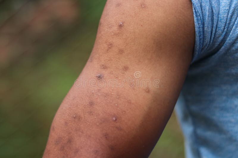 Black marks on human hand stock image. Image of pain - 204999669