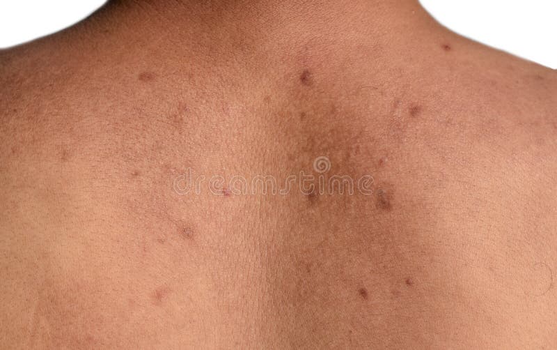 Black Spots and Scars on the Back Stock Image - Image of acnes, natural ...