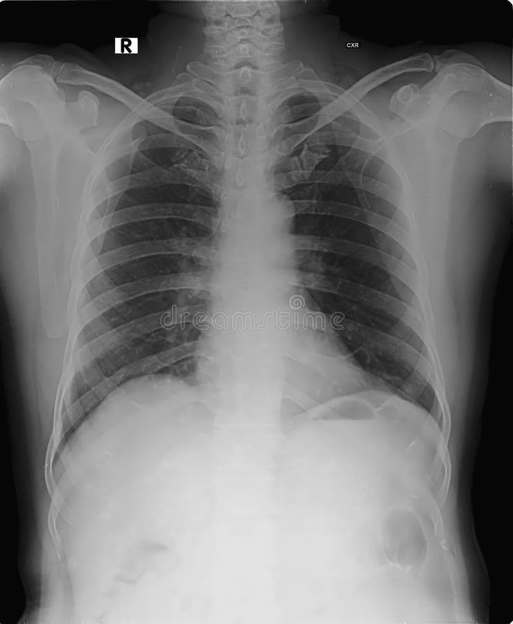 A Black and White X-ray of a Person S Chest Stock Image - Image of ...