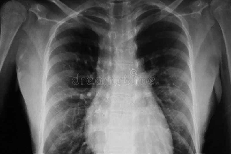 Black and White Torso X-ray Film Image Stock Photo - Image of skeleton ...