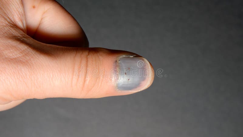 Blackened Nail of Hand - Left Stock Photo - Image of unpleasant ...