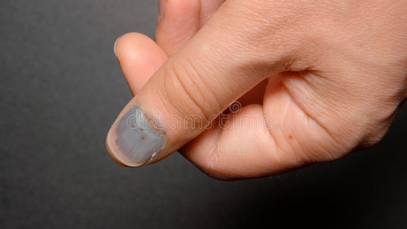 Blackened nail of hand stock image. Image of young, medical - 88421331