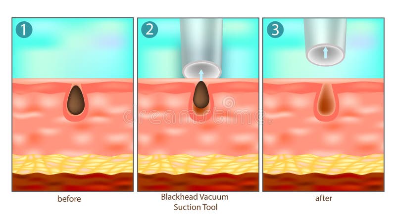 Blackhead Removal Process Using Vacuum Suction Tool - before and after ...