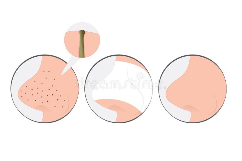 Blackheads on Nose stock vector. Illustration of care - 131203501