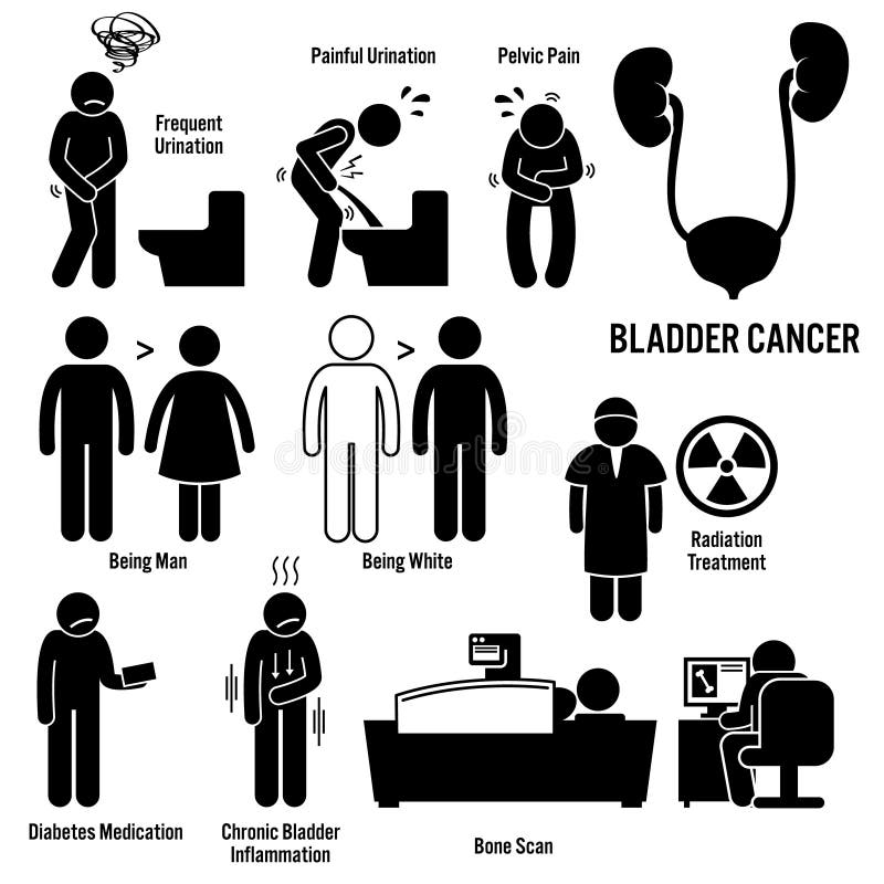 Bladder cancer stages stock illustration. Illustration of inside - 10332957
