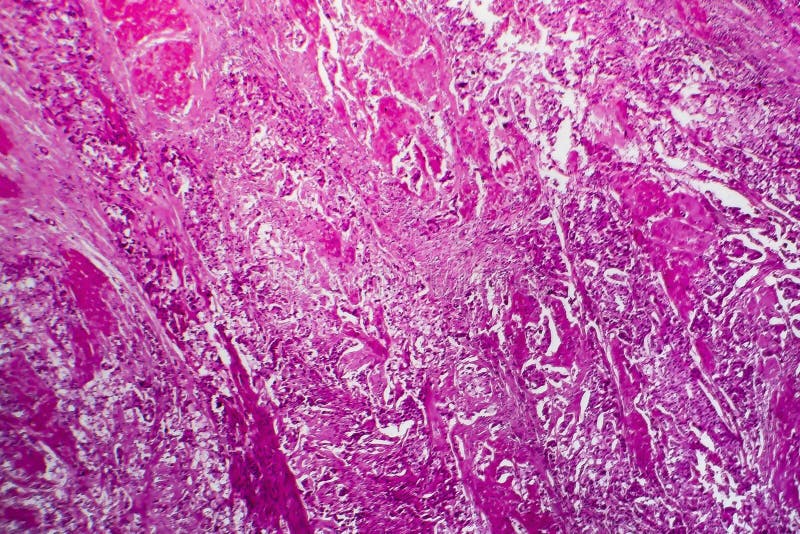 Bladder Cancer, Light Micrograph Stock Photo - Image of histopathology ...