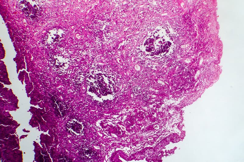 Bladder Cancer, Light Micrograph Stock Photo - Image of neoplasm ...