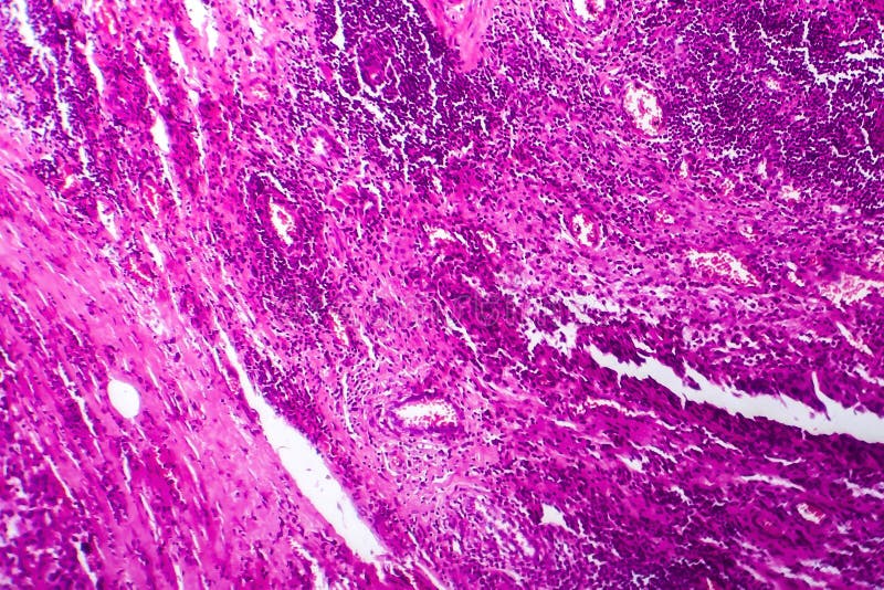 Bladder Cancer, Light Micrograph Stock Image - Image of micro, cell ...