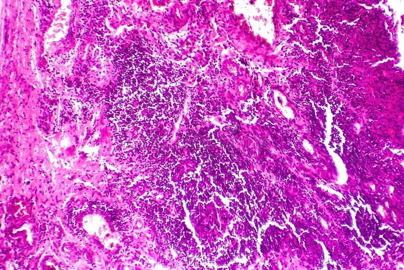 Bladder Cancer, Light Micrograph Stock Photo - Image of pathology ...