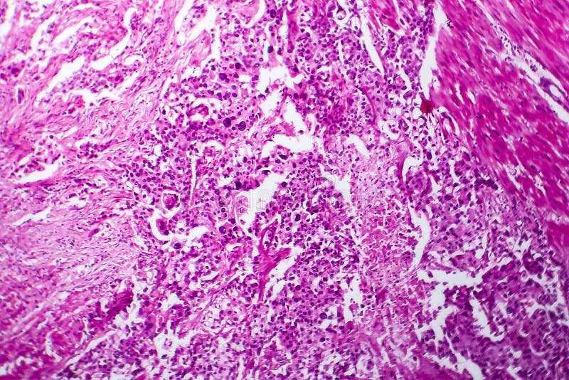 Bladder Cancer, Light Micrograph Stock Photo - Image of eosin, urine ...