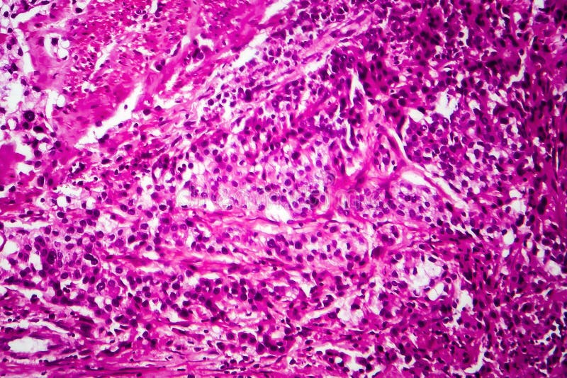 Bladder Cancer, Light Micrograph Stock Image - Image of morphological ...