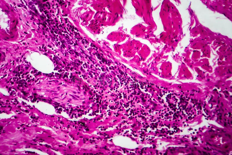 Bladder Cancer, Light Micrograph Stock Photo - Image of neoplasm ...