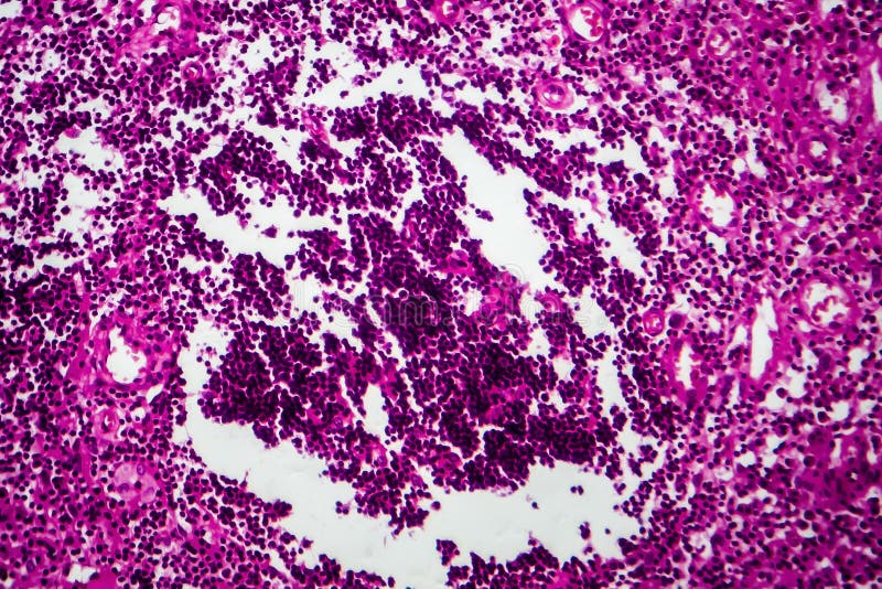 Bladder Cancer, Light Micrograph Stock Photo - Image of medical ...