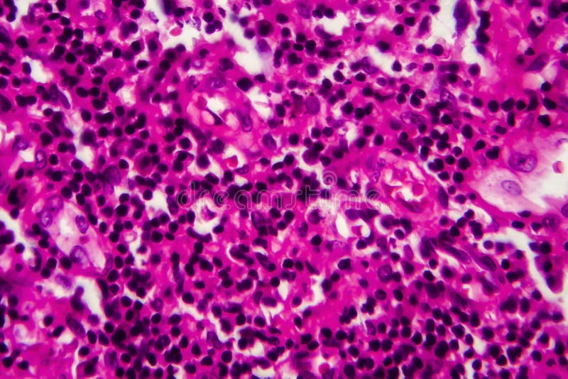 Bladder Cancer, Light Micrograph Stock Photo - Image of neoplasm ...