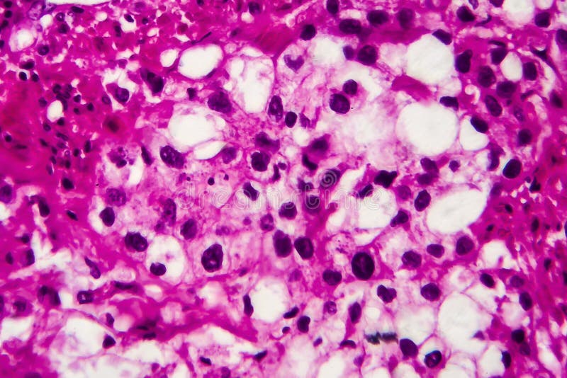 Bladder Cancer, Light Micrograph Stock Photo - Image of neoplasm ...