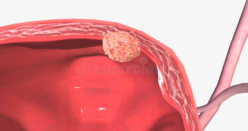 The Bladder Cancer, Stage II Stock Illustration - Illustration of ...