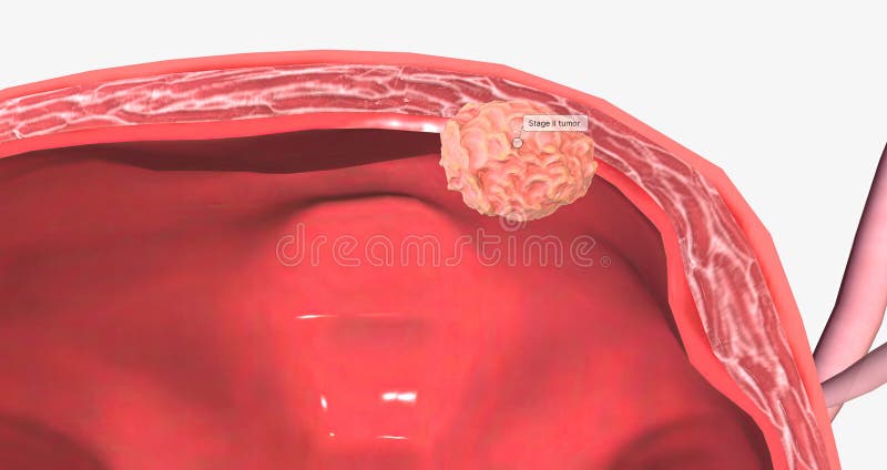 The Bladder Cancer, Stage II Stock Illustration - Illustration of ...