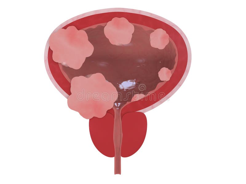 Bladder cancer stages stock illustration. Illustration of inside - 10332957