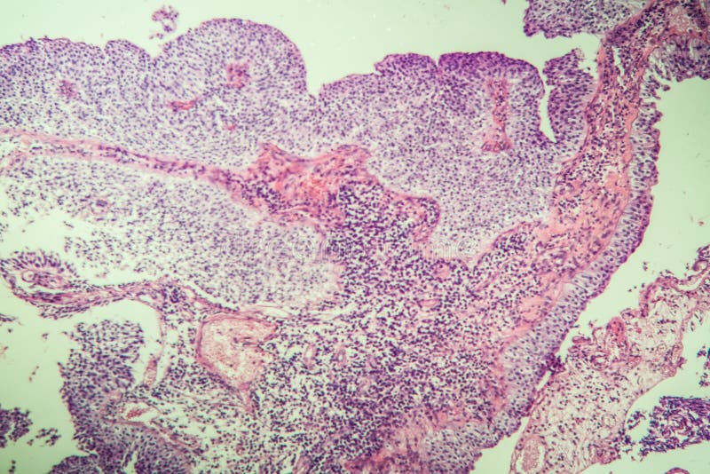 Papilloma Bladder Prognosis Stock Photos - Free & Royalty-Free Stock ...