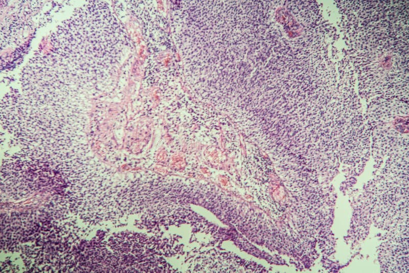 Bladder Papilloma Sick Tissue Under the Microscope Stock Photo - Image ...