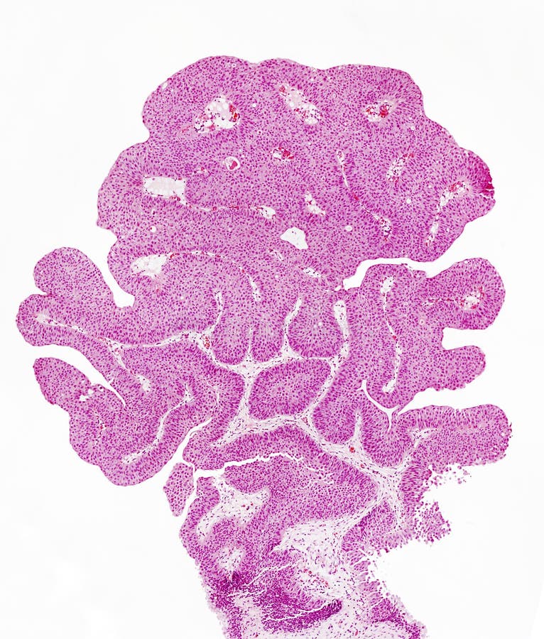 Bladder polyp stock image. Image of investigation, bladder - 18130811