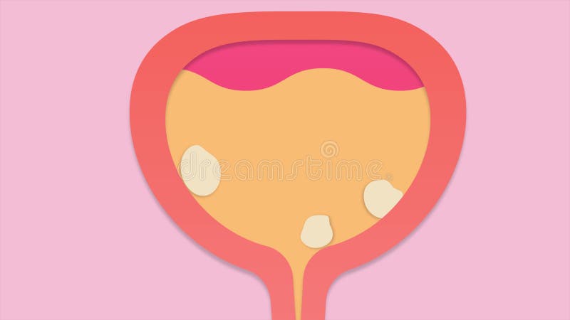 Bladder Stones. Abstract Loop Animation Stock Footage - Video of ...