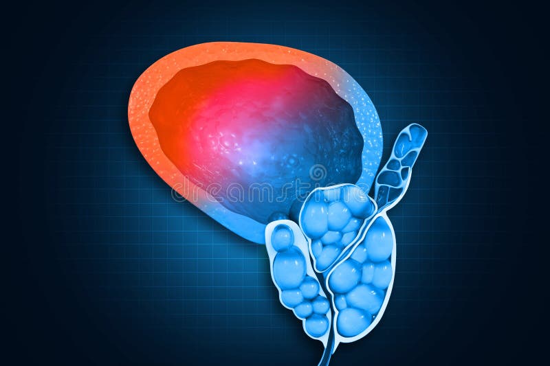 Bladder Stones. Cross Section Stock Illustration - Illustration of duct ...