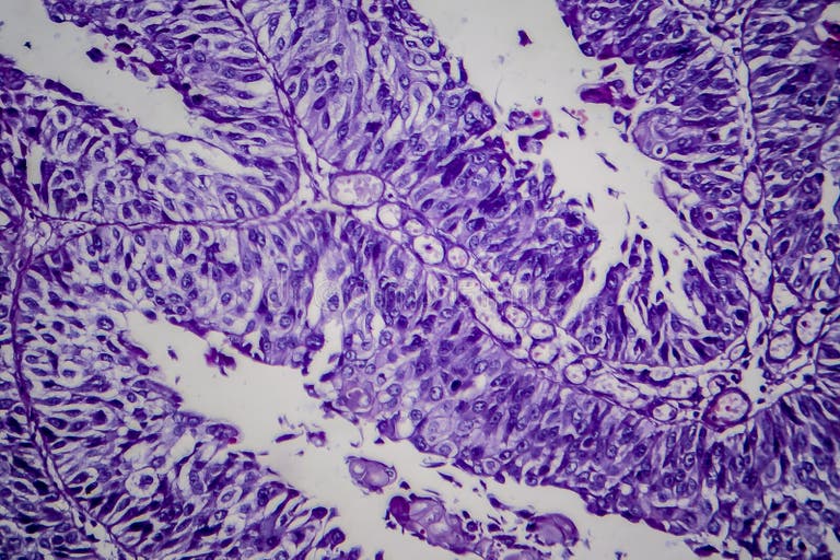 Bladder Transitional Cell Carcinoma, Light Micrograph Stock Image ...