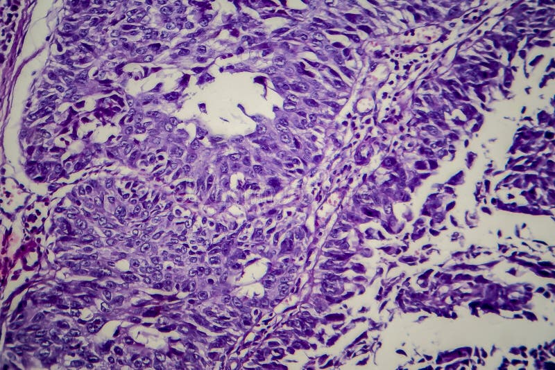 Bladder Transitional Cell Carcinoma, Light Micrograph Stock Photo ...