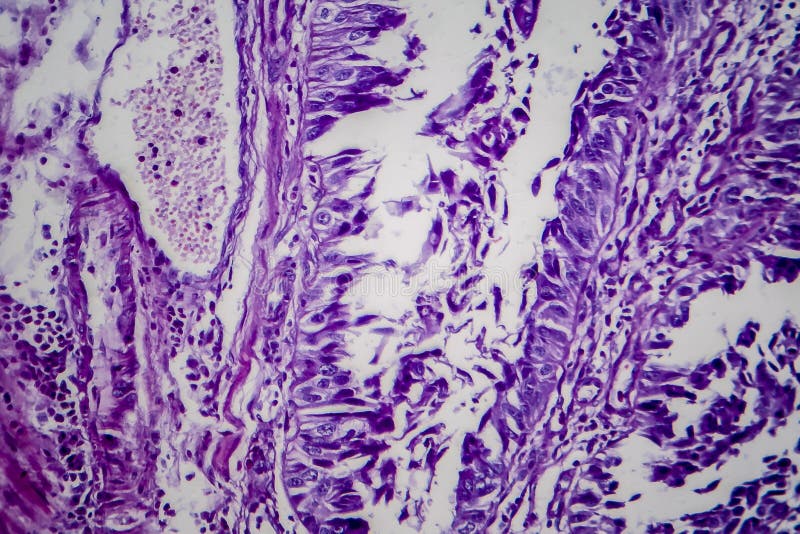 Bladder Transitional Cell Carcinoma, Light Micrograph Stock Photo ...