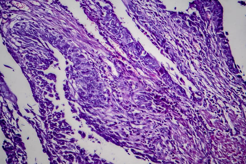 Bladder Transitional Cell Carcinoma, Light Micrograph Stock Image ...