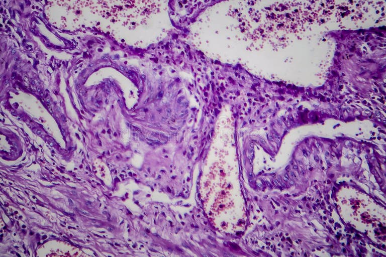 Bladder Transitional Cell Carcinoma, Light Micrograph Stock Image ...