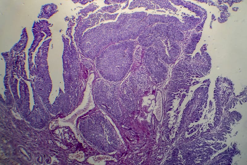 Bladder Transitional Cell Carcinoma, Light Micrograph Stock Photo ...