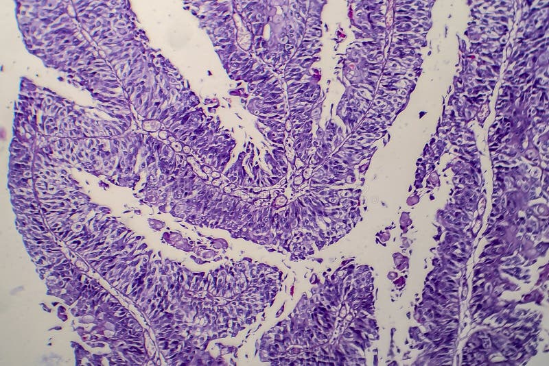 Bladder Transitional Cell Carcinoma, Light Micrograph Stock Image ...