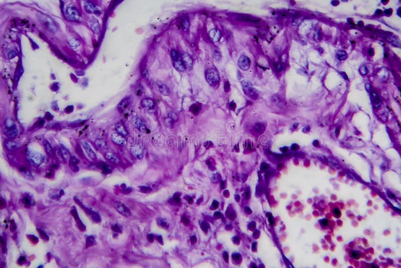 Bladder Transitional Cell Carcinoma, Light Micrograph Stock Photo ...