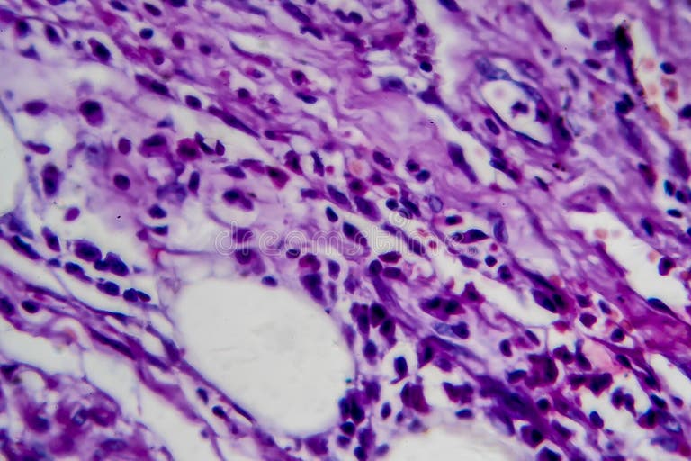 Bladder Transitional Cell Carcinoma, Light Micrograph Stock Image ...