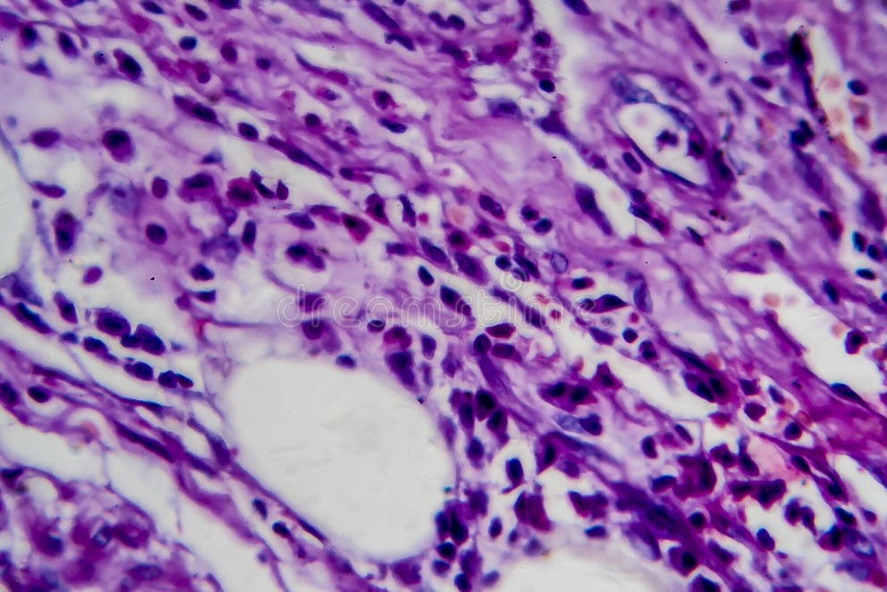 Bladder Transitional Cell Carcinoma, Light Micrograph Stock Image ...