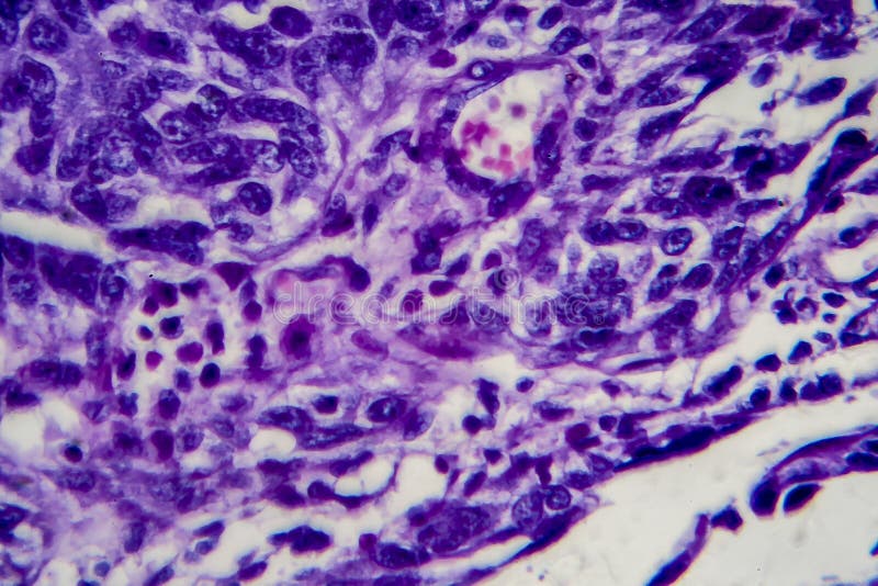 Bladder Transitional Cell Carcinoma, Light Micrograph Stock Photo ...