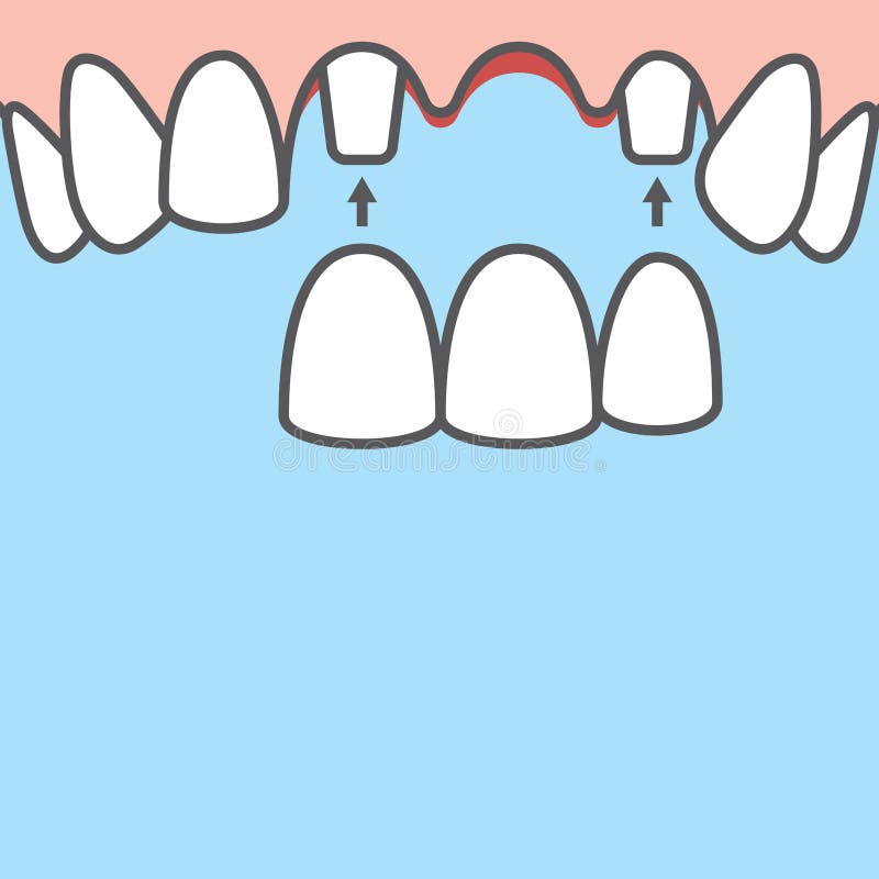 Dental Bridges Stock Illustrations – 311 Dental Bridges Stock ...