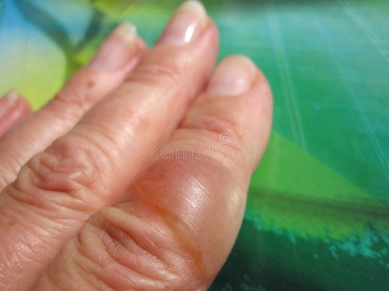 Het Close-up Op Vinger Met Pijnlijk Inflammed Fluid-filled Blaar Stock ...