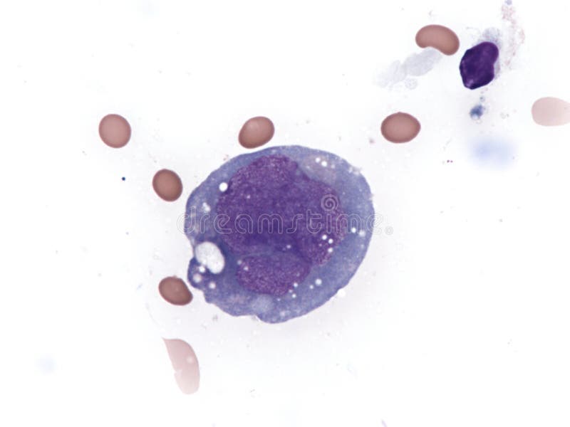 Blast Cell in Acute Myeloid Leukemia. Stock Photo - Image of clinical ...