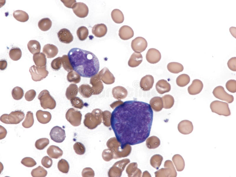 Blast Cell in Acute Myeloid Leukemia. Stock Photo - Image of oncology ...
