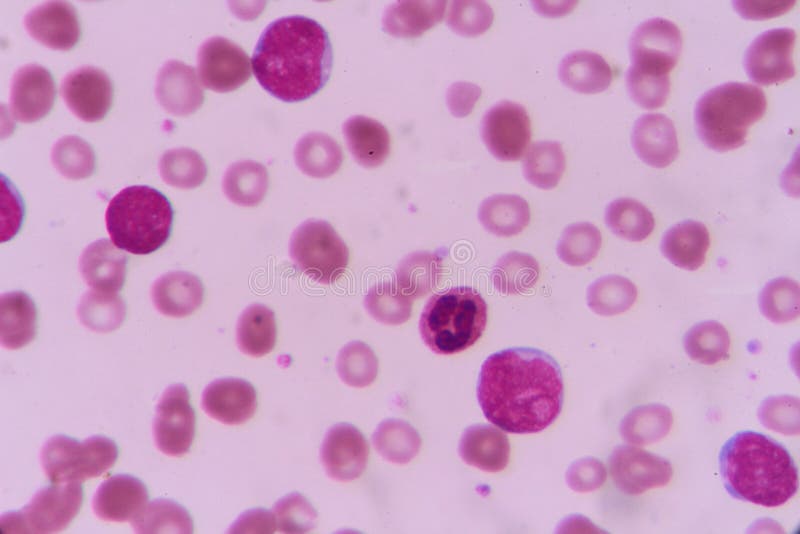Blast Cells of White Blood Cell. Stock Photo - Image of background ...