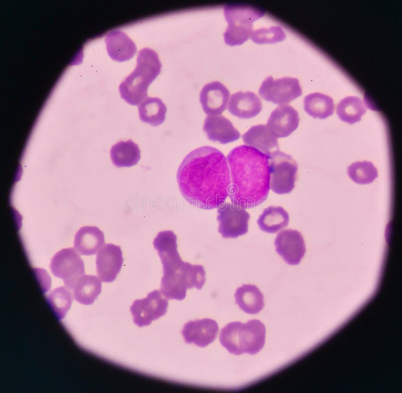 Blast cell on blood smear. stock photo. Image of blood - 96652954