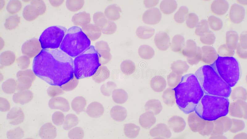 Blast Cell in Leukemia Pateins in Blood Smear Stock Image - Image of ...