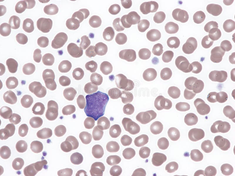Blast Cell in Peripheral Blood (Natalizumab). Stock Image - Image of ...