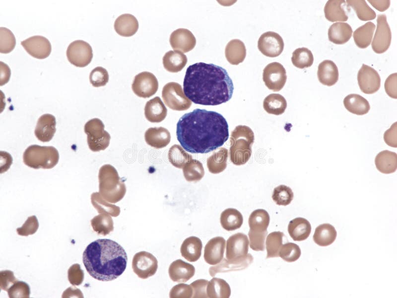 Blast Cells in Acute Myeloid Leukemia. Stock Photo - Image of neurology ...