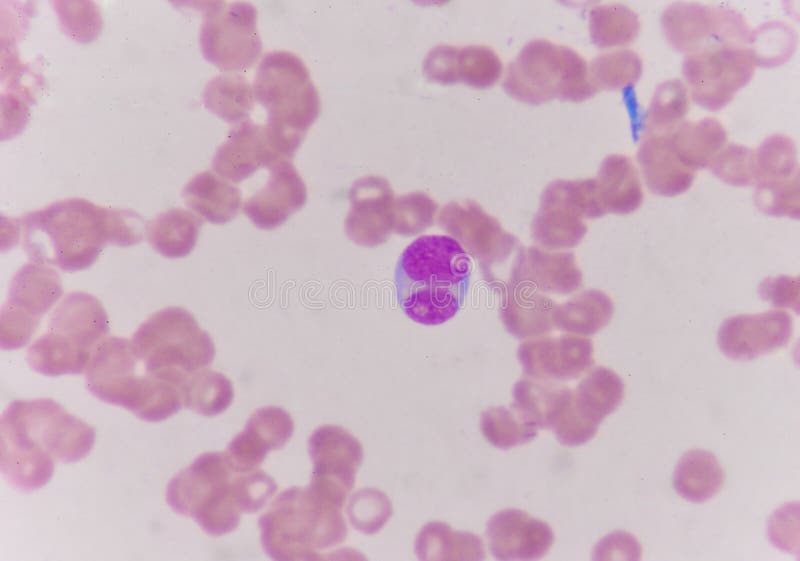 Blast Cells of White Blood Cell. Stock Photo - Image of background ...