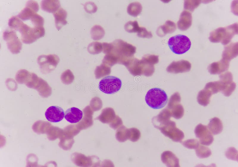 Blast Cells in Blood Smear. Stock Photo - Image of basophil, abnormal ...